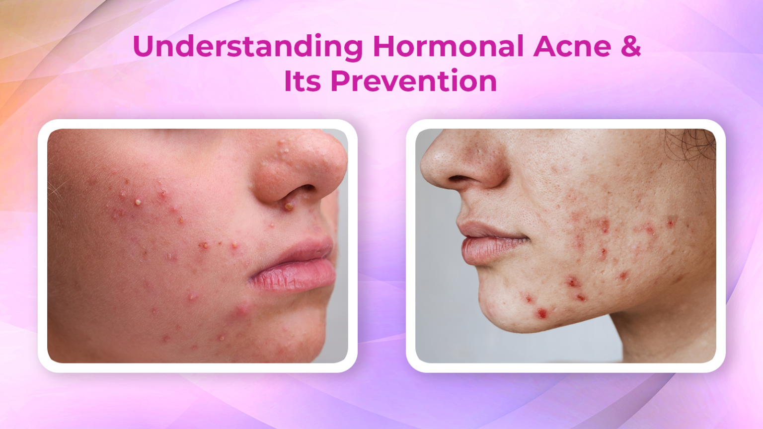 Hormonal Acne: Causes, Prevention & Treatment