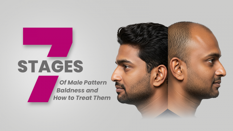 7 Stages of Male Pattern Baldness and How to Treat Them
