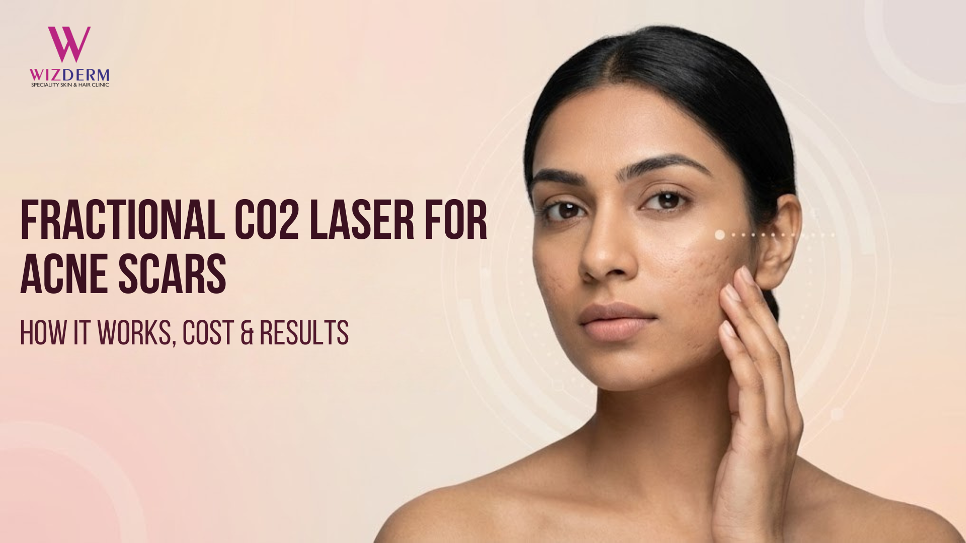 Fractional CO₂ Laser for Acne Scars: How It Works, Cost & Results
